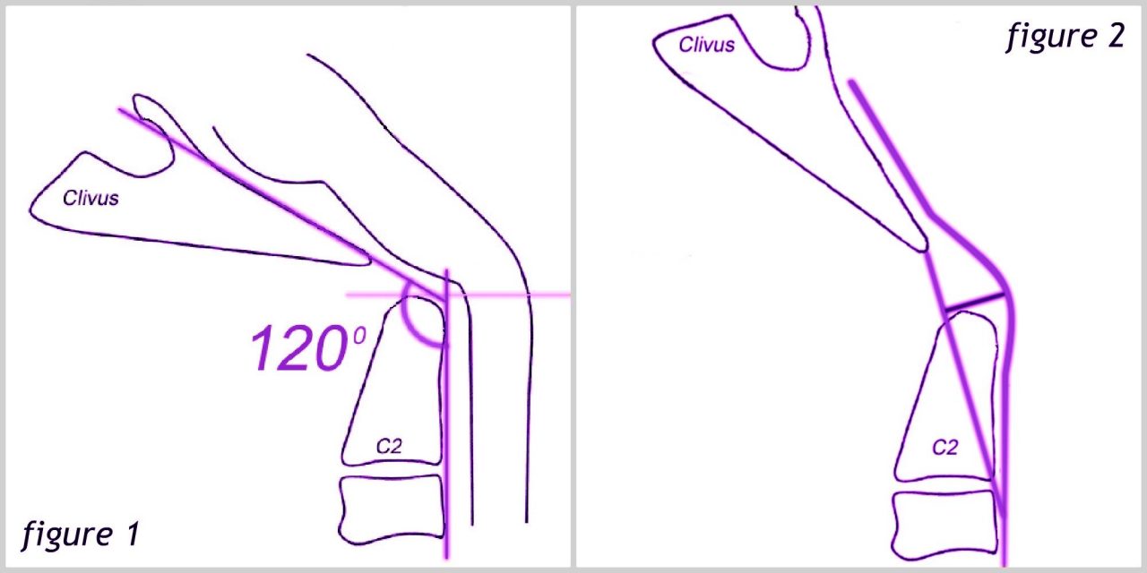 Overview: Craniocervical Instability and Related Disorders - Chiari Bridges