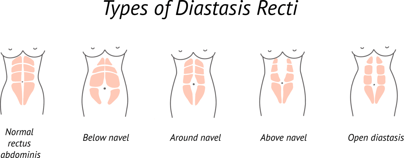 Spine Pulled Tight – A Guide to Understanding Tethered Cord Syndrome ...