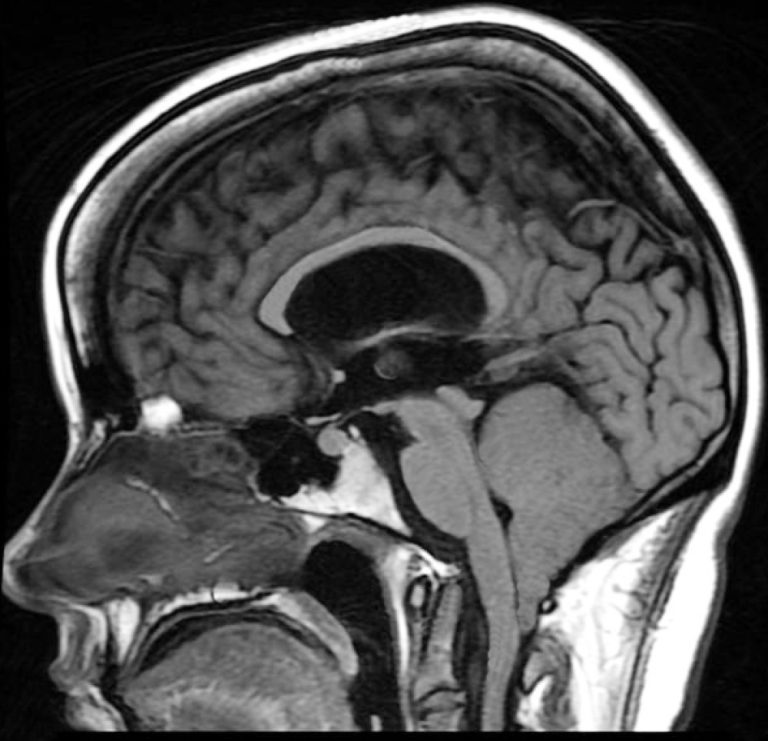 Chiari 2, Explained - Chiari Bridges